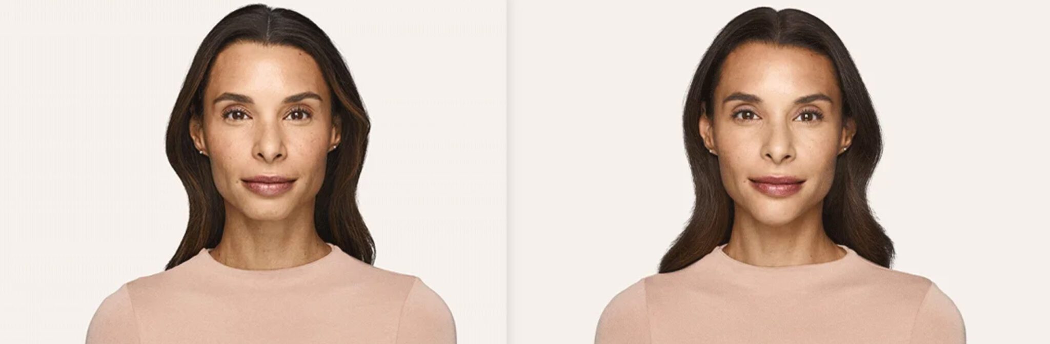 How Much Does Juvederm Volux Cost? Jaw Line Dermal Filler Orlando, FL