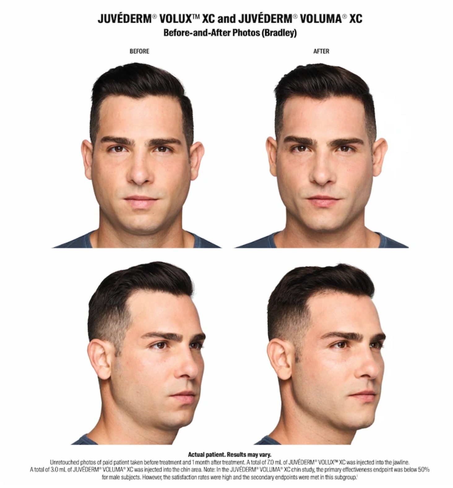 Juvederm Volux Dermal Filler Before and After Photos Orlando Florida