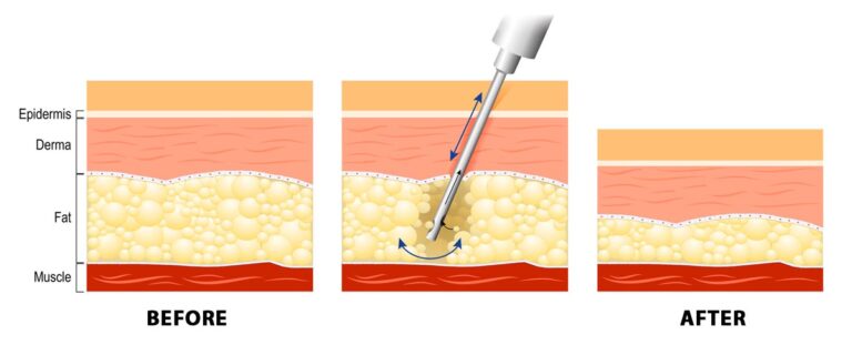 Tumescent Liposuction vs Traditional Liposuction - Orlando FL Plastic ...