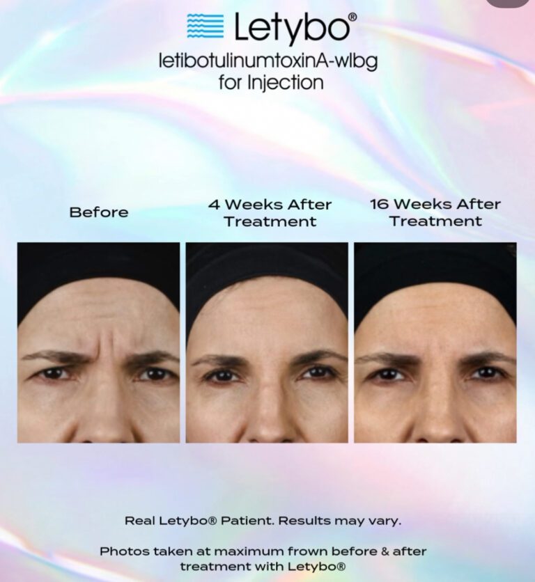 Letybo (Korean Botox) Before & After Photos Orlando FL Medical Spa