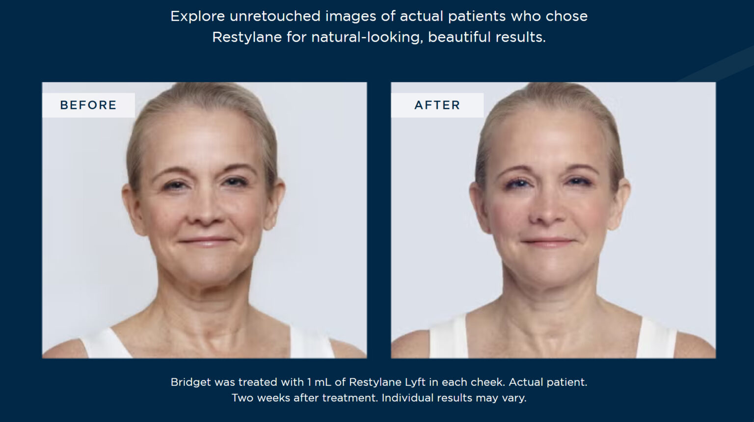 Restylane for Under-Eye Hollows | Eyelight, Refyne, Lyft Benefits ...